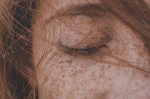 What percentage of people have freckles? – My Web Stats